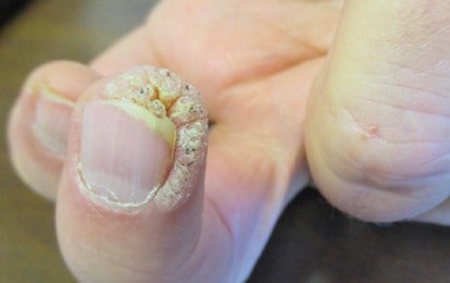 درمان زگیل با بهترین روش‌ها و شرح انواع آن — مجله زیبایی لیا